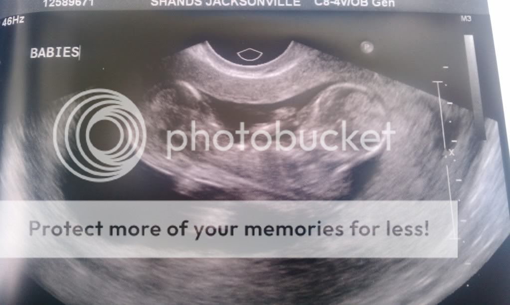 Monoamniotic twins.... - BabyCenter